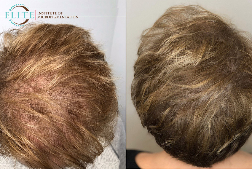 Scalp Micropigmentation Atlanta, GA | Elite Institute of Micropigmentation
